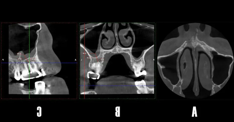 ¿Para qué se realiza la sinusitis maxilar en la cirugía oral y ...